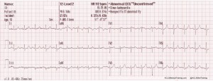Treating Supraventricular Tachycardia with Adenosine