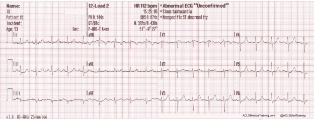 Treating Supraventricular Tachycardia with Adenosine