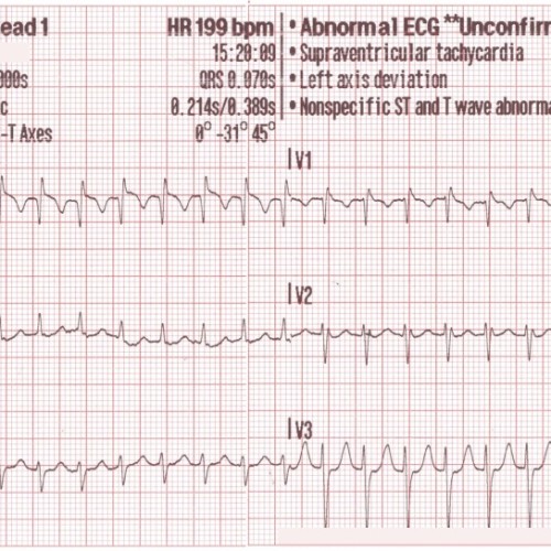 Treating Supraventricular Tachycardia with Adenosine - ACLS Medical ...
