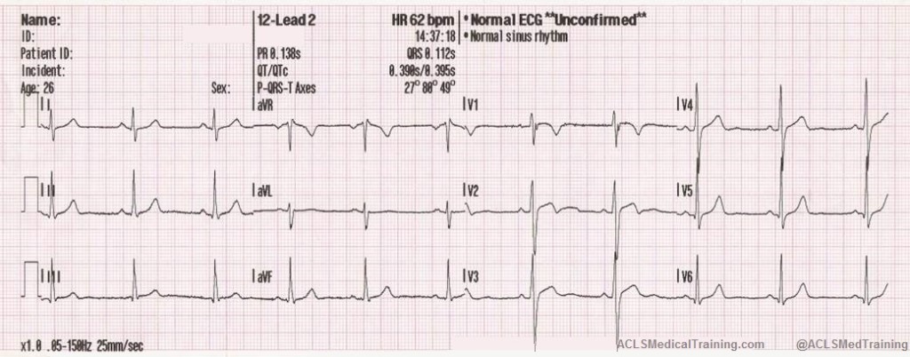 Types of ECG Artifacts | Understanding Interference