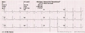 Types of ECG Artifacts | Understanding Interference