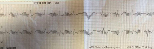 Types of ECG Artifacts | Understanding Interference