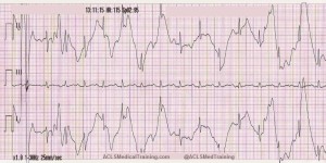 Types of ECG Artifacts | Understanding Interference