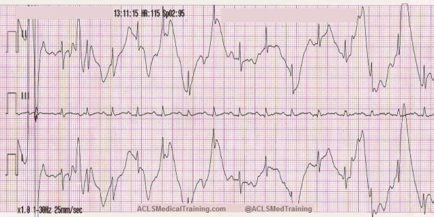 Types of ECG Artifacts | Understanding Interference