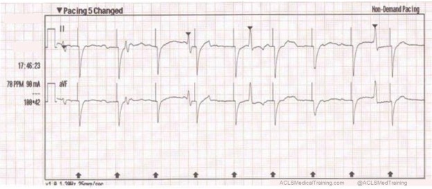 Types of ECG Artifacts | Understanding Interference