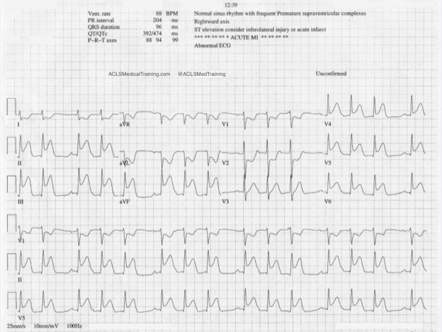 Syncope With Acute Inferior Stemi And 3 Different Av Blocks Acls