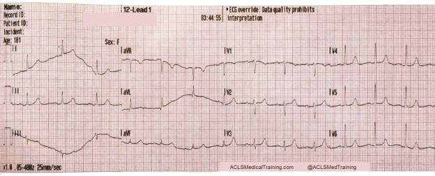 Types of ECG Artifacts | Understanding Interference