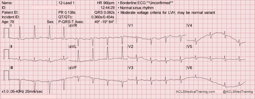 Types of ECG Artifacts | Understanding Interference