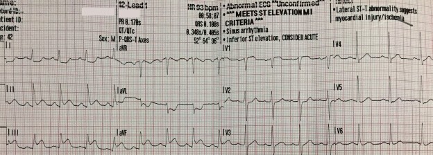 Acute Inferior STEMI with Right Ventricular Infarction and Cardiac ...