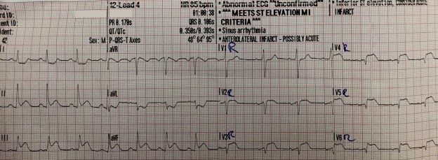 Acute Inferior STEMI with Right Ventricular Infarction and Cardiac ...