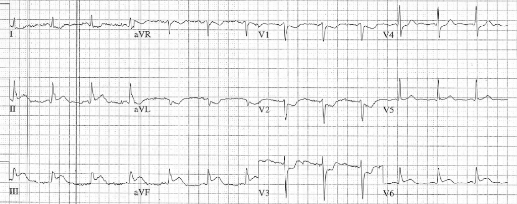 Cardiac Cath Lab Activation for Subtle Acute Inferior STEMI - ACLS ...