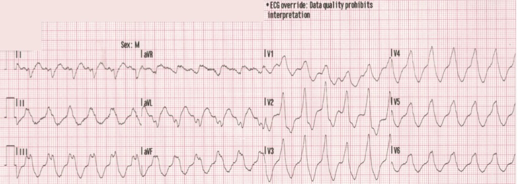 Myths and Cognitive Biases in Interpretation of Wide Complex ...