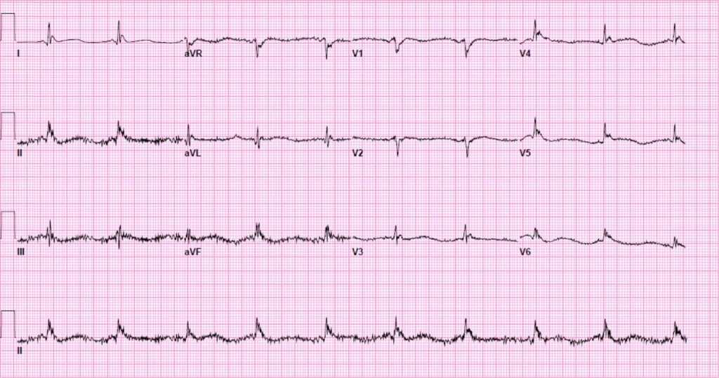 55 year old male with altered mental status, hypothermia, and Osborn ...