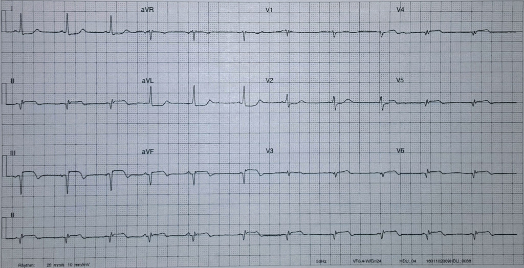 Mechanical Complications of STEMI - ACLS Medical Training