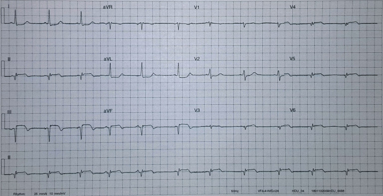 Mechanical Complications of STEMI - ACLS Medical Training