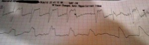 Transcutaneous Pacing (TCP) With and Without Capture - ACLS Medical ...