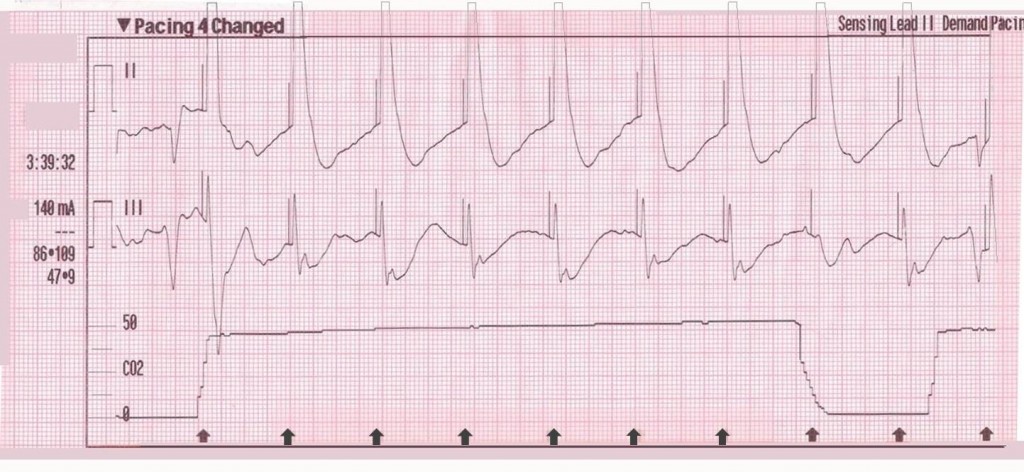 Transcutaneous Pacing (TCP) With and Without Capture - ACLS Medical ...