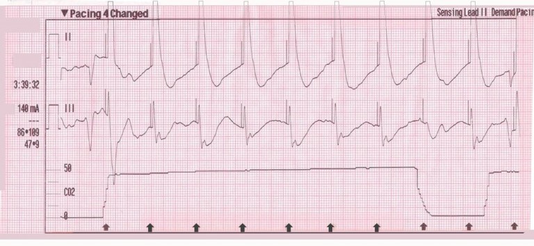 Transcutaneous Pacing (TCP) With and Without Capture - ACLS Medical ...