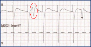 Transcutaneous Pacing (TCP) With and Without Capture - ACLS Medical ...