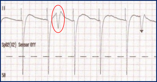 Transcutaneous Pacing Tcp With And Without Capture Acls Medical Training
