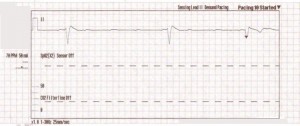 Transcutaneous Pacing (TCP) With and Without Capture - ACLS Medical ...