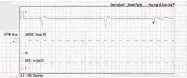 Transcutaneous Pacing (TCP) With and Without Capture - ACLS Medical ...