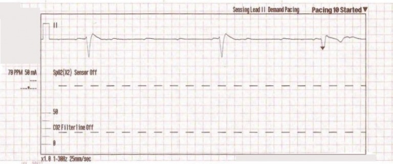 Transcutaneous Pacing (TCP) With and Without Capture - ACLS Medical ...