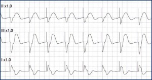 Transcutaneous Pacing (TCP) With and Without Capture - ACLS Medical ...