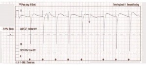 Transcutaneous Pacing (TCP) With and Without Capture - ACLS Medical ...
