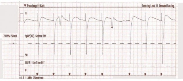 Transcutaneous Pacing (TCP) With and Without Capture - ACLS Medical ...