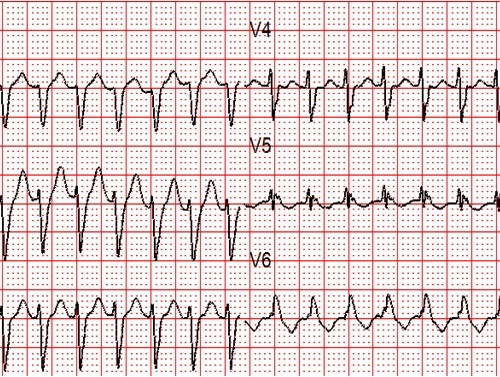 Acute Inferior STEMI with Right Ventricular Infarction and Cardiac ...