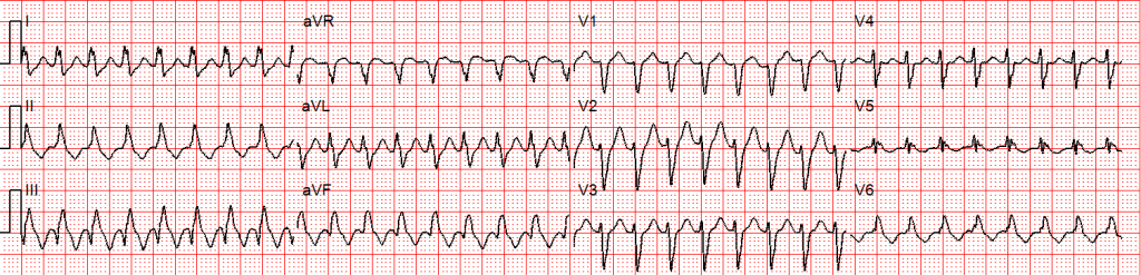 SVT with Aberrancy ACLS Management