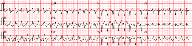 SVT with Aberrancy ACLS Management