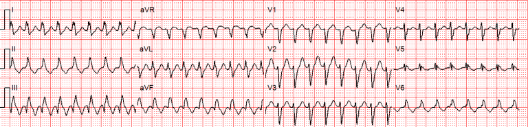SVT with Aberrancy ACLS Management