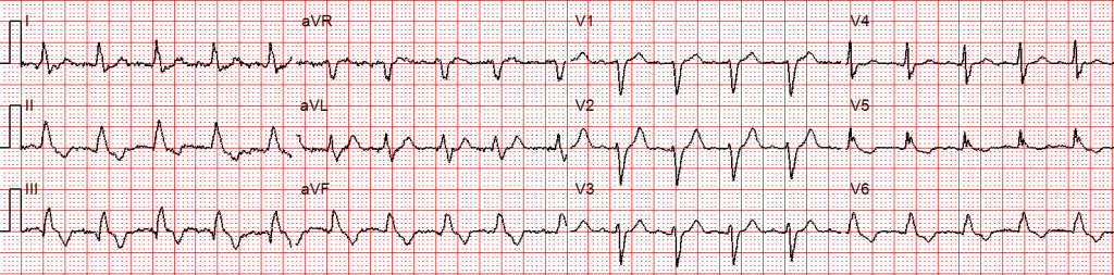 SVT with Aberrancy ACLS Management