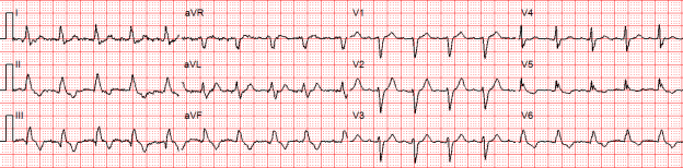 SVT with Aberrancy ACLS Management