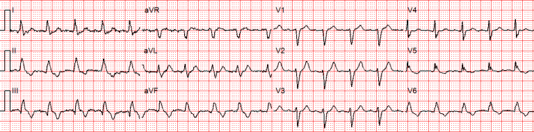 SVT with Aberrancy ACLS Management