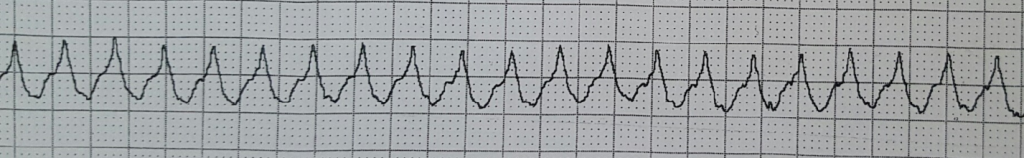 SVT with Aberrancy ACLS Management