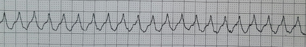 SVT with Aberrancy ACLS Management