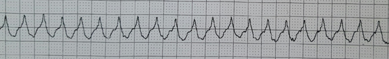 SVT with Aberrancy ACLS Management